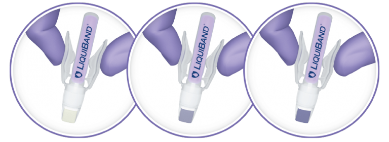 LiquiBand® Exceed™ - Controlled Wound Closure