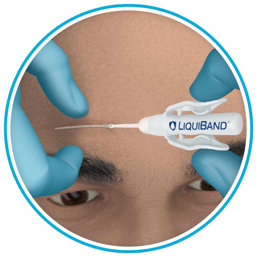 LiquiBand® Optima - Topical Skin Adhesive - Wound Closure